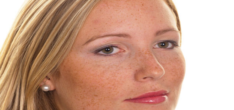 5 Effective Ways to Fade Hyperpigmentation Naturally - theskinartistry