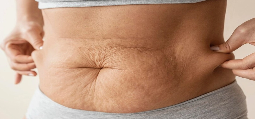 Tips to Combat Stubborn Stretch Marks - theskinartistry