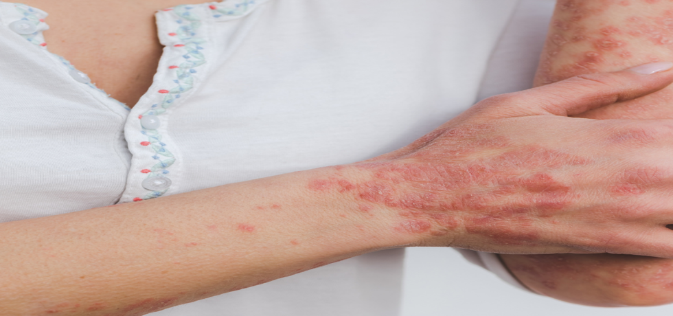 Understanding Lichen Planus: Your Complete Guide - theskinartistry Understanding Lichen Planus: Your Complete Guide - theskinartistry