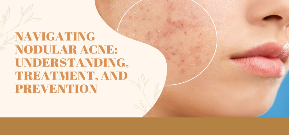 Mastering Nodular Acne: A Comprehensive Guide - theskinartistry