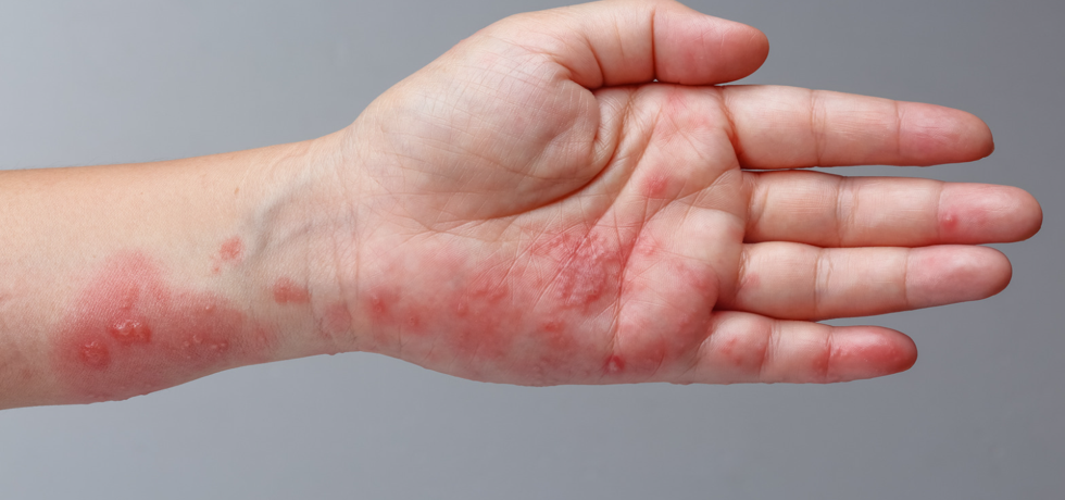Understanding Heat Rash: Causes, Symptoms, and Treatments - theskinartistry